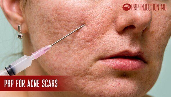 PRP Therapy for Injury Scars | PRP for Skin Repair