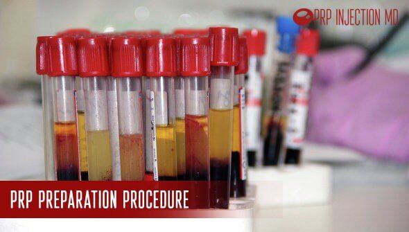 PRP Preparation | Plasma Therapy | PRP Injection MD